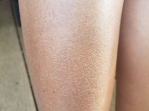 What Causes Strawberry Legs and How to Get Rid of It | Expert Skincare ...