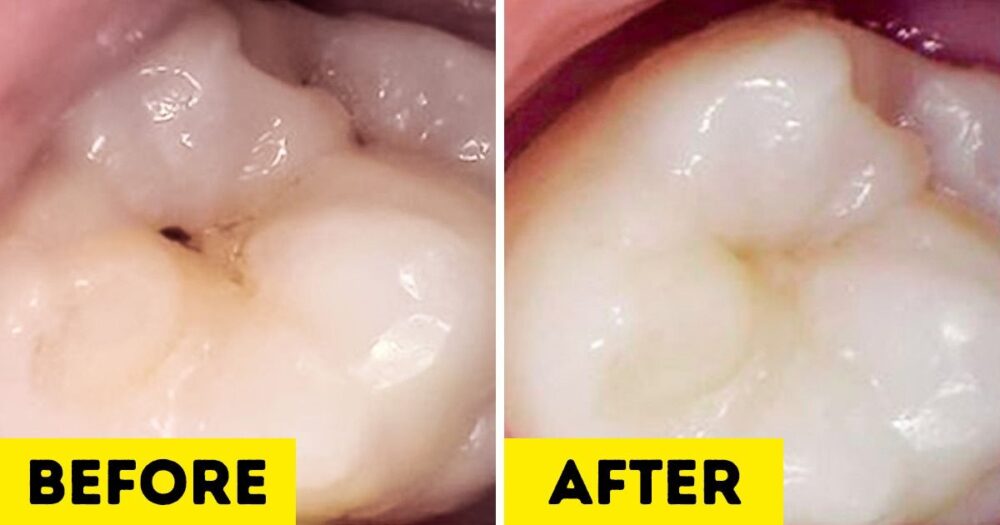 5 Types of Tummies & How to Slim Each One: Expert Belly Fat Loss Tips ...